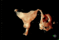 Clinical Image Gallery – ExEm Foam